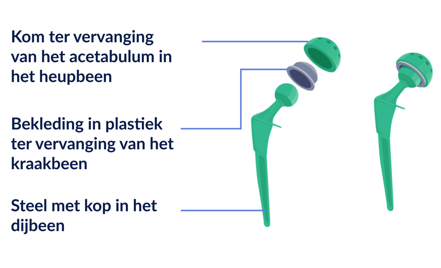 Anatomie, artrose en totale heupvervangingsoperatie – Support ...